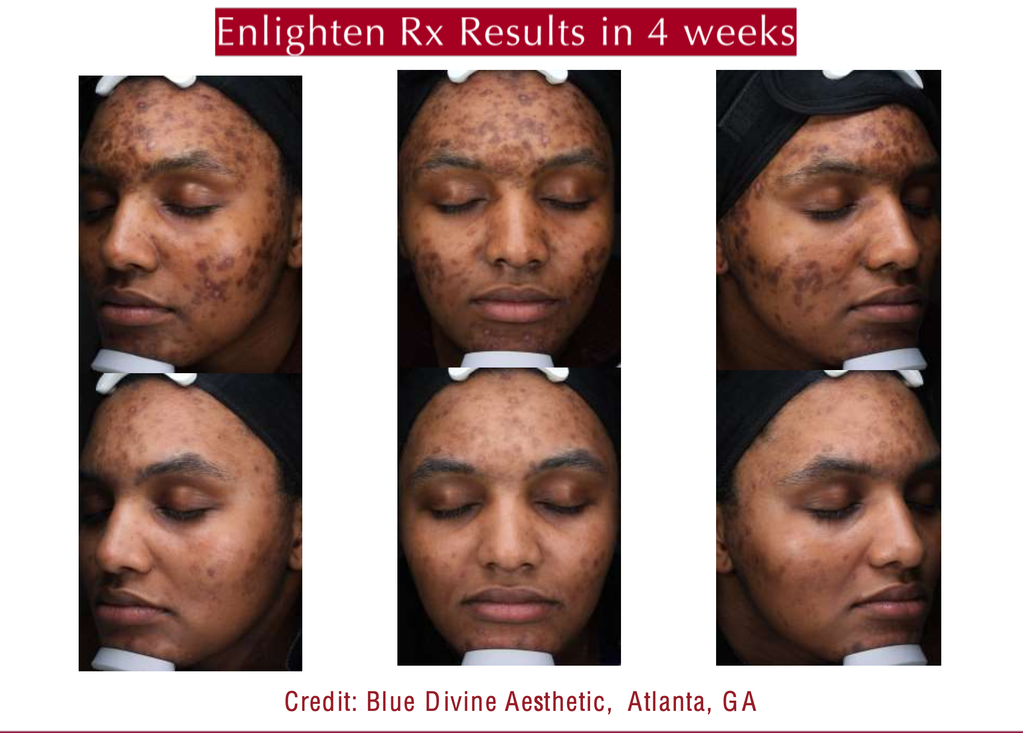 Enlighten Depigmentation Peel - SKIN CABINET